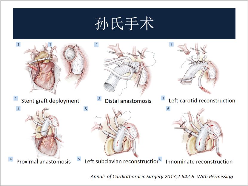 The "Gold Standard" in Cardiac Surgery: Conquering Porcelain Aorta at ...