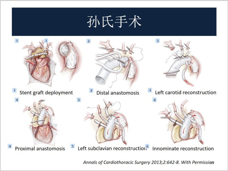 The "Gold Standard" in Cardiac Surgery: Conquering Porcelain Aorta at ...